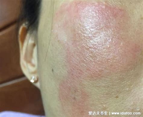 脸部过敏性皮炎图片和症状丘疹红斑瘙痒避免抓痒 3种类型图 花胶养生之家
