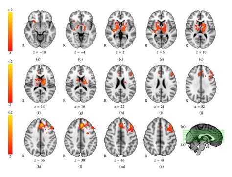 Visual Memory Fmri Task Between Groups T 2 Versus T 1 Anova Regions Download Scientific