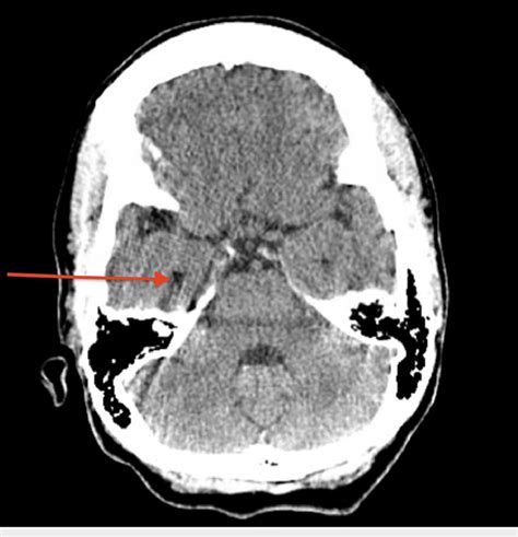 CT Scan Coronal View Of The Head Without Contrast The Image Is