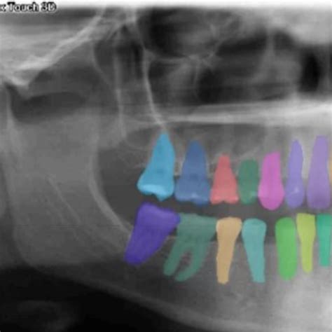 Teeth Segmentation On Dental X Ray Images Kaggle