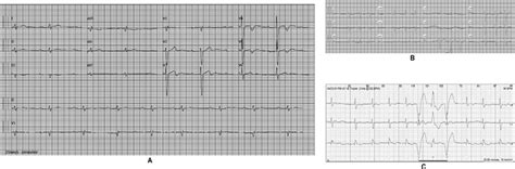 Electrocardiograms From Patient Ii 2 A Ecg In Sinus Rhythm St T