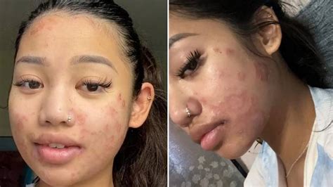 Woman Gets Ringworm After Sharing Makeup Brushes With Her Friends