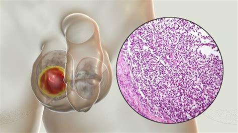 Testis Tümörü Tedavisi Ürolog Doktor