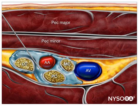 The Best Way To Learn Or Teach Infraclavicular Block Nysora