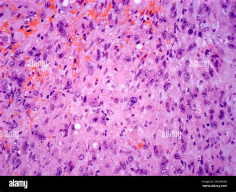 Vascular Tumour Light Micrograph Of A Section Through A Metastatic Secondary