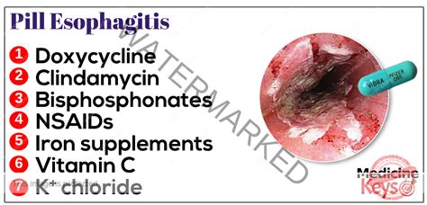 Drugs Causing Pill Esophagitis Medicine Keys For Mrcps
