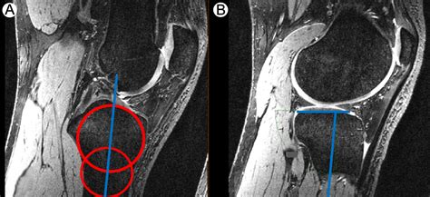 ACL Repair Vs ACL Reconstruction Which Approach Is Right For You Phynofest