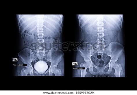 Compare Intravenous Pyelogram Ivp Xray Exam Stock Photo 1559916029 Shutterstock