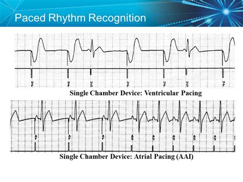 Cvt Mohd Farid Pacemaker Follow Up Part I Medtronic Academy