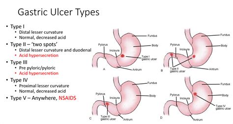 Gastric Ulcer Types Gastric Ulcer Types