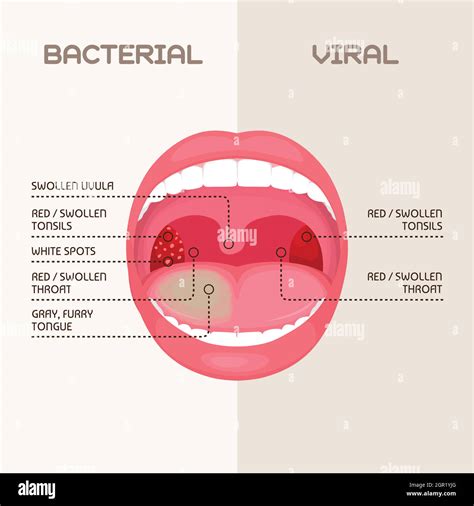 Tonsillitis Bacterial Viral Angina Pharyngitis Tonsillitis 47 Off
