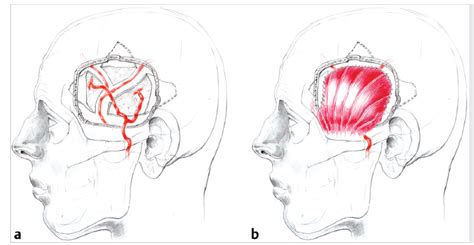15 Sta Mca Bypass And Emsedms Neupsy Key