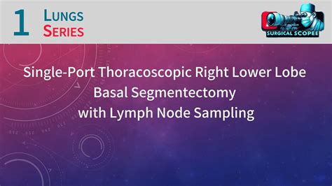 Single Port Thoracoscopic Right Lower Lobe Basal Segmentectomy Youtube