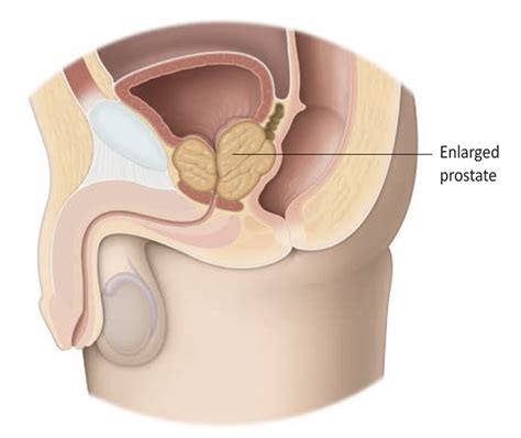Benign Prostate Enlargement — Urology Care Toowoomba Dr Nikhil Sapre