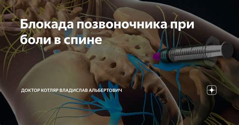 Блокада позвоночника при боли в спине | Доктор Котляр Владислав ...