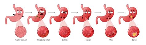 위장병 감정이 있는 만화 캐릭터 다이어그램 질병 헬리코박터 파일로리 위염 침식 궤양 암 교육용 해부학적 벡터 그림입니다 건강관리와 의술에 대한 스톡 벡터 아트 및 기타