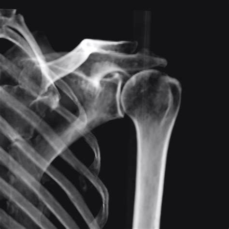 Shoulder And Arm X Ray At Bertha Arrington Blog