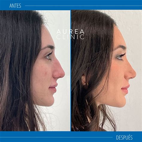 Rinoplastia Tradicional Y Rinoplastia Ultrasónica Antes Y Después