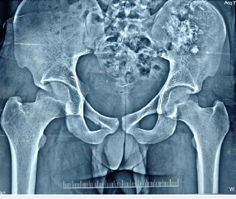 Preoperative Radiograph Showing Popcorn Calcifications On The Download Scientific Diagram