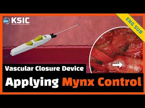 [sub]applying Mynx Control Vascular Closure Device Youtube
