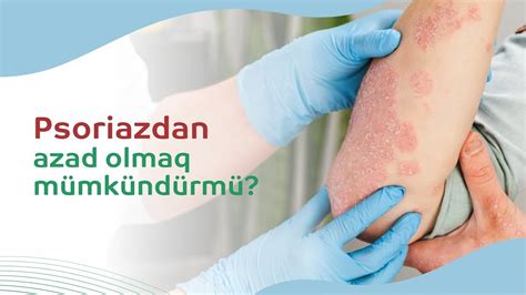 Psoriaz Və Ya “pullu Dəmirov” Psoriazın Uğurlu Müalicəsi Nədən