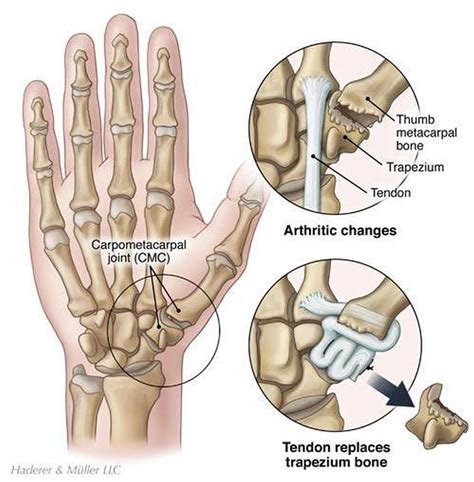 Pictures Of Carpometacarpal Joints