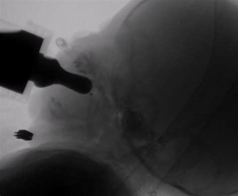 Foundational Information Pediatric Dysphagia And Feeding Disorders — Tims Medical