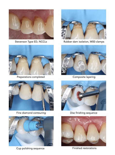 Composite Class V Restorations Lesion Specific Approaches