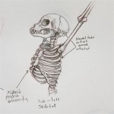 Xiphoid Process Protrusion
