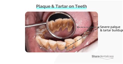 Severe Plaque On Teeth Share Dental Care