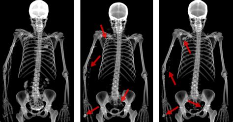 Coronal Projections Of Segmentation Outputs Of Internal Dataset 2 For