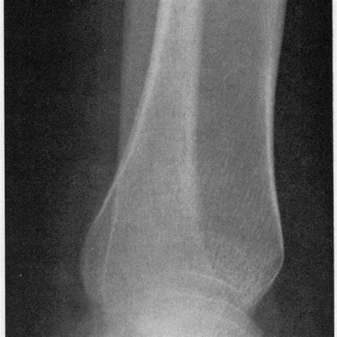 Radiograph Of The Left Ankle Showing Calcification Of Anterior And Download Scientific