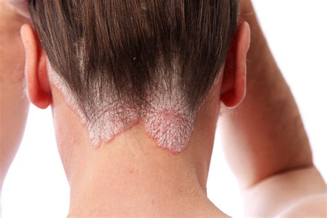 Scalp Psoriasis Symptoms Causes Treatment And Tips