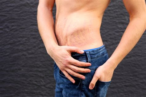 How To Love Your Stretch Marks POPSUGAR Beauty