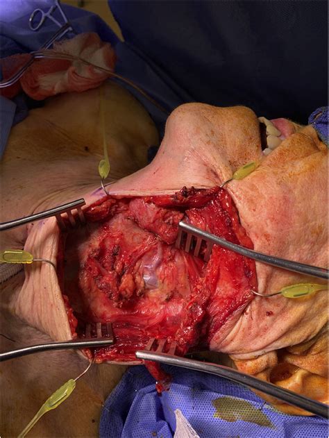 Neck Dissection