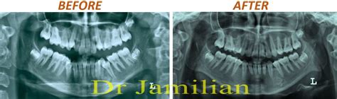Dr Jamilian Orthodontic Clinic Case Reports Class Ii Div 2