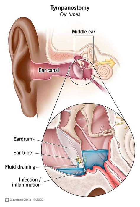 Ear Tubes Tympanostomy Definition And Procedure In 2022 Ear Tubes Ear Drainage Ear Wax Buildup