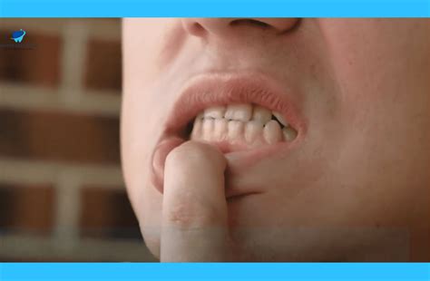 What Is Hypocalcification Teeth All You Need To Know