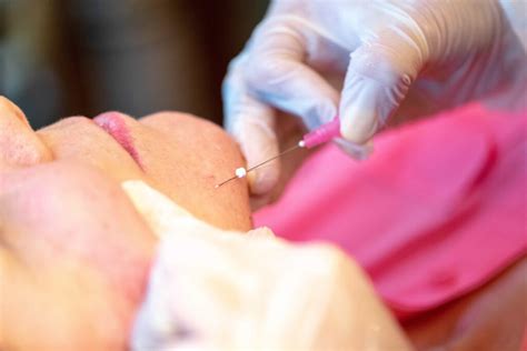 Pdo Lifting Threads Aesthetics Hq