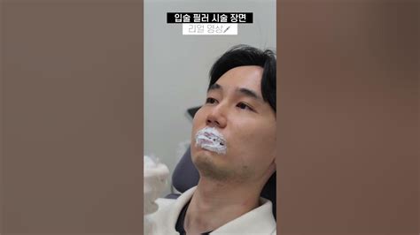 입술 필러 리얼 시술 현장 전후 대박이죠 Shorts Youtube