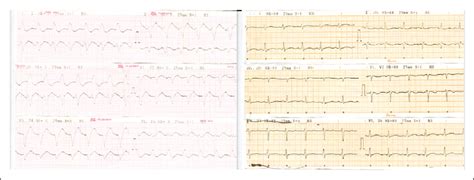 The Patient S ECG Before Left And After Right The Completion Of The Download Scientific