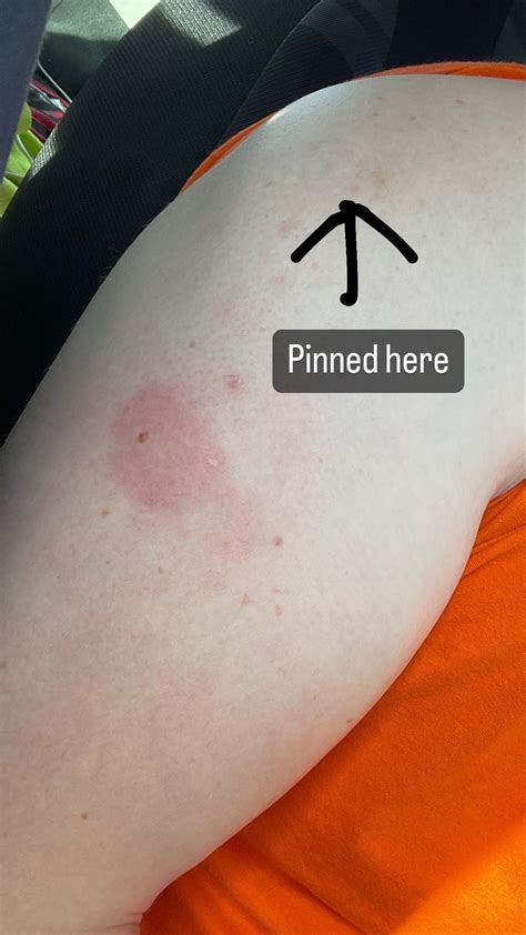 Bulge After Pin Rsteroidsuk