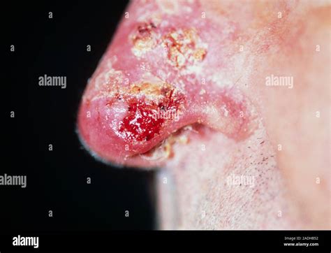 Skin Cancer Squamous Cell Carcinoma On The Nose Of A 57 Year Old Man Squamous Cells Are Flat