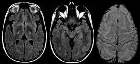 Dr Balaji Anvekar Frcr Amyotrophic Lateral Sclerosis