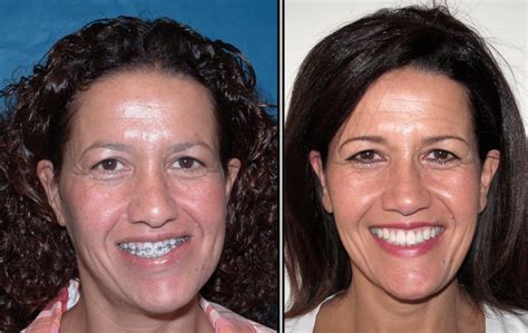 Before After Case A Facial Asymmetry Surgery