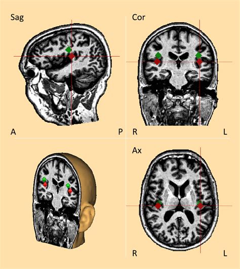 Besa® Brain Electrical Source Analysis Features Individual Fem Head Model
