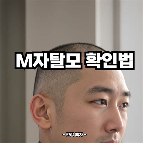 M자탈모 확인법 7가지 정확하게 자가진단하는 방법 건강 부자