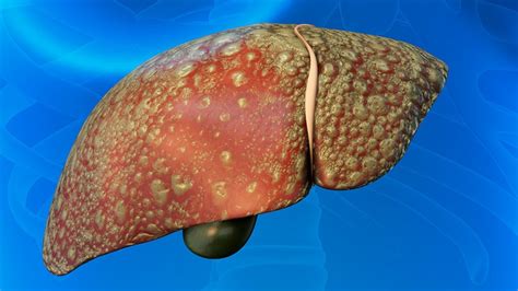 Ema Recommends Rezdiffra For Mash Liver Fibrosis