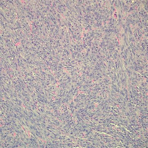 Cellular Malignant Spindle Cell Proliferation Arranged In Intersecting