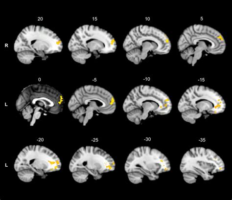 Increased Neural Activation Of The Bilateral Medial Prefrontal Cortex Download Scientific